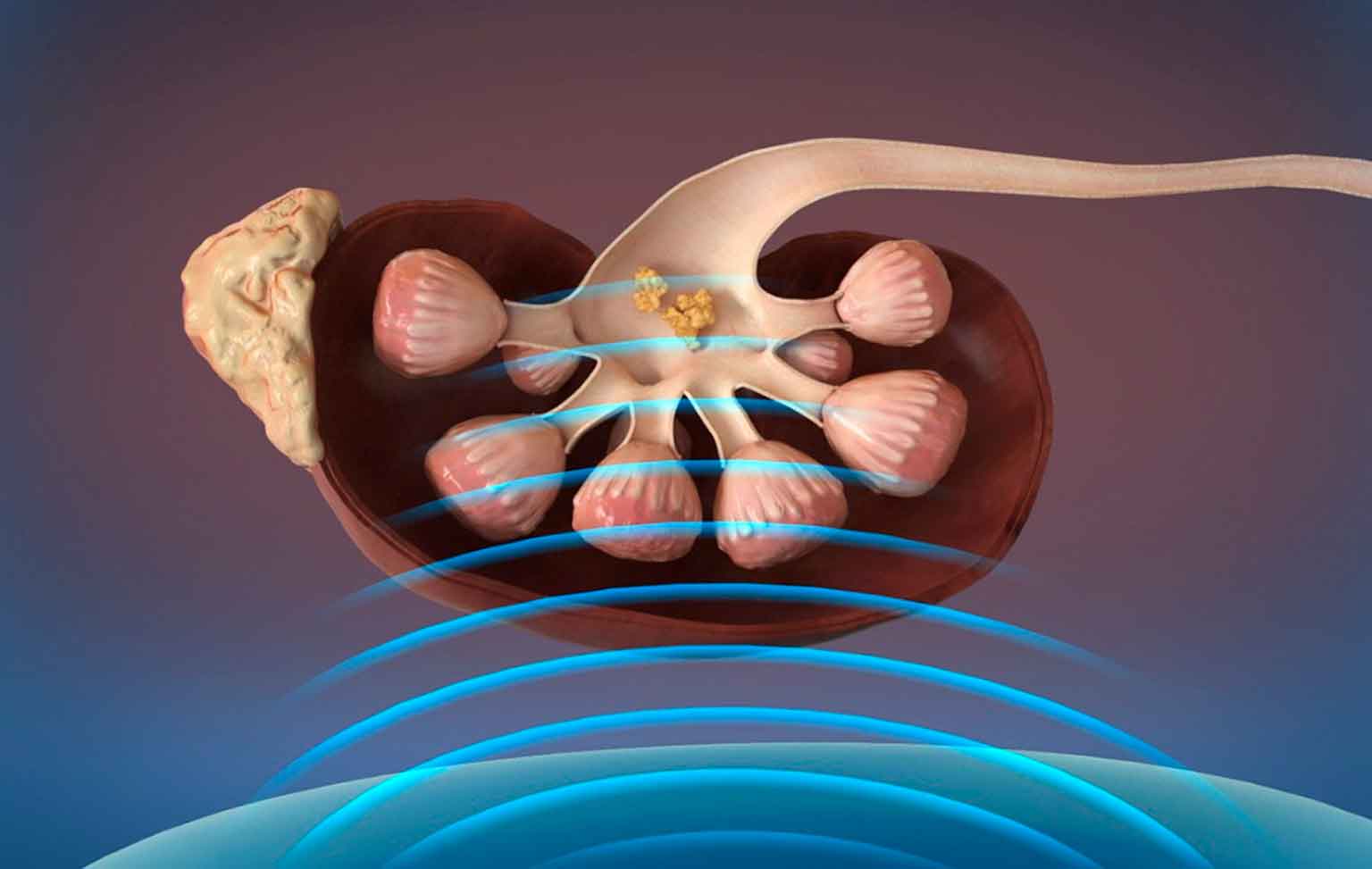 ¿Qué es la litotripcia extracorpórea?